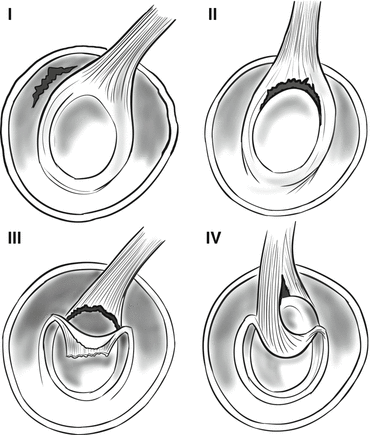 SLAP Lesions | SpringerLink