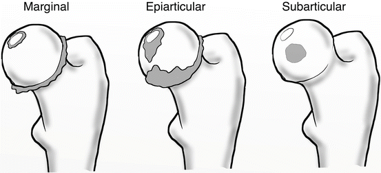 Femoral Head Osteophytes | SpringerLink