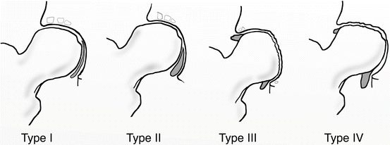 Femoral Head Osteophytes | SpringerLink
