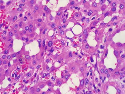 Epithelioid Hemangioma | SpringerLink