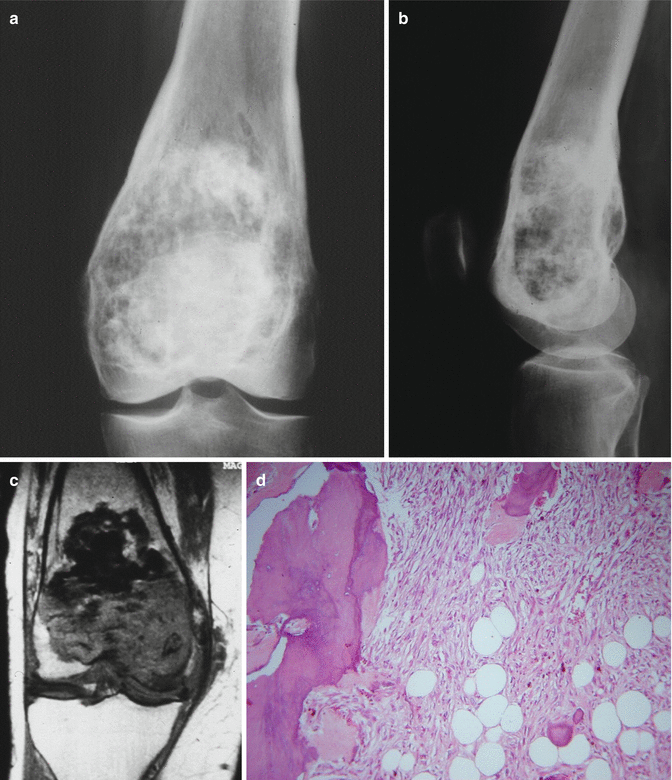 Bone Infarct | SpringerLink