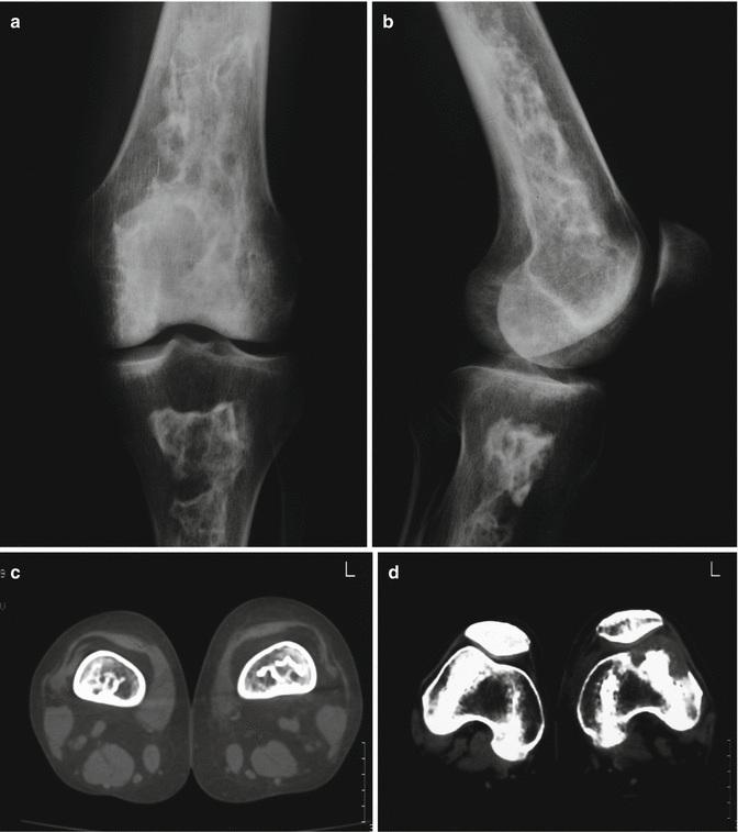 Bone Infarct | SpringerLink