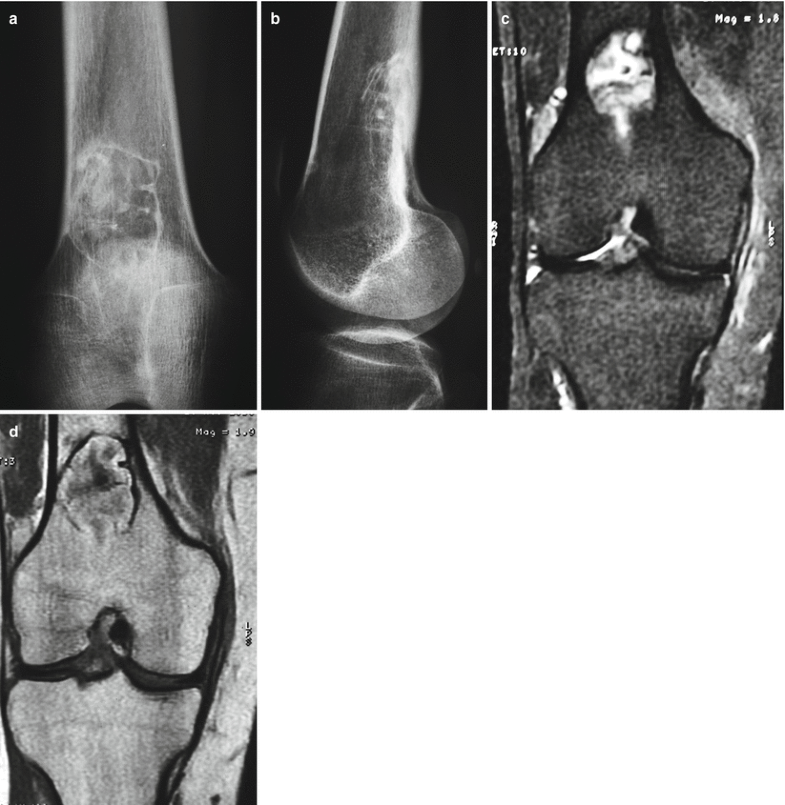Bone Infarct | SpringerLink