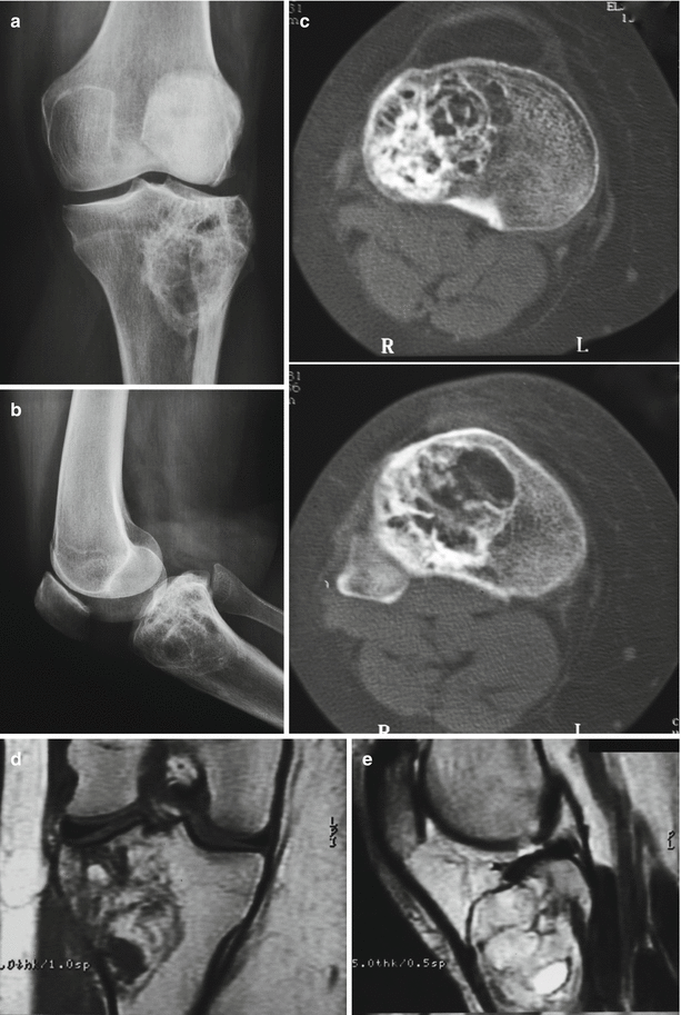 Bone Infarct | SpringerLink