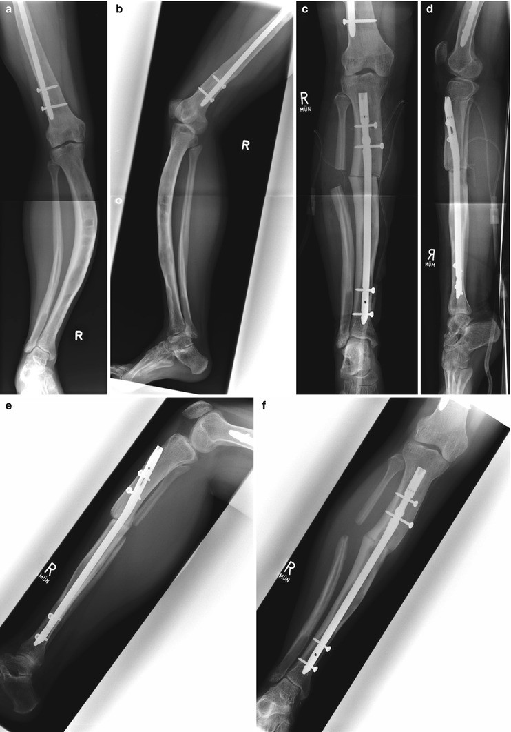 Congenital Bone Disorders | SpringerLink