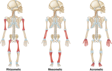 Skeletal Dysplasia | SpringerLink