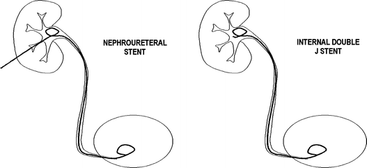 Percutaneous Nephrostomy Placement | SpringerLink