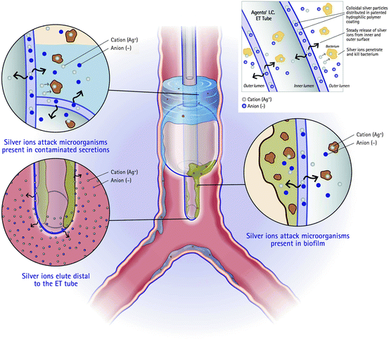 Preventive Strategies in VAP: Focus on Silver-Coated Endotracheal Tubes ...