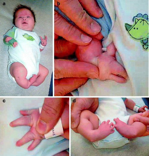 Dysmelia | SpringerLink