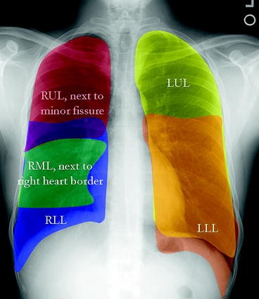 Normal Chest X-Ray, Terminology and Radiographic Anatomy | SpringerLink