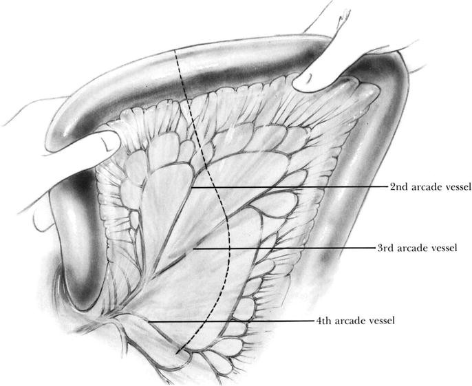 Roux-en-Y Biliary-Enteric Bypass | SpringerLink