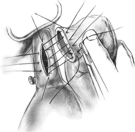 Roux-en-Y Biliary-Enteric Bypass | SpringerLink