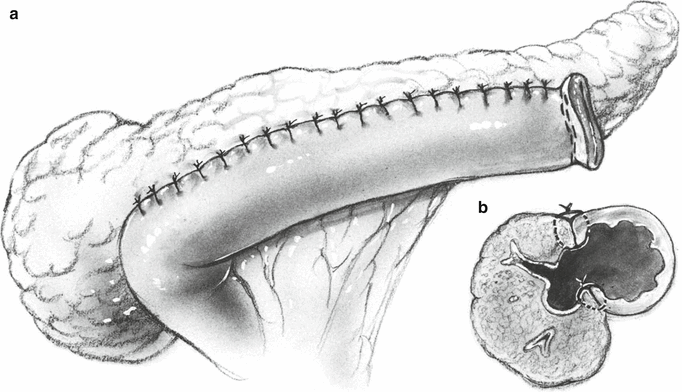 Pancreaticojejunostomy (Puestow) for Chronic Pancreatitis | SpringerLink