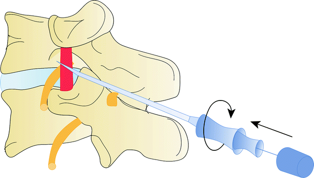 The Racz Procedure: Lysis of Epidural Adhesions (Percutaneous ...