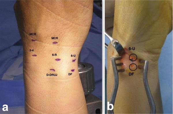 Arthroscopic Wrist Anatomy and Setup | SpringerLink