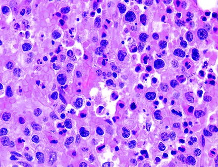 Lymphocytic Effusions | SpringerLink