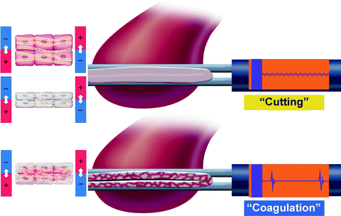 Fundamentals of Electrosurgery Part I: Principles of Radiofrequency ...