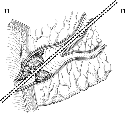 Ampulla of Vater | SpringerLink
