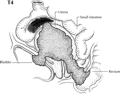 Corpus Uteri | SpringerLink