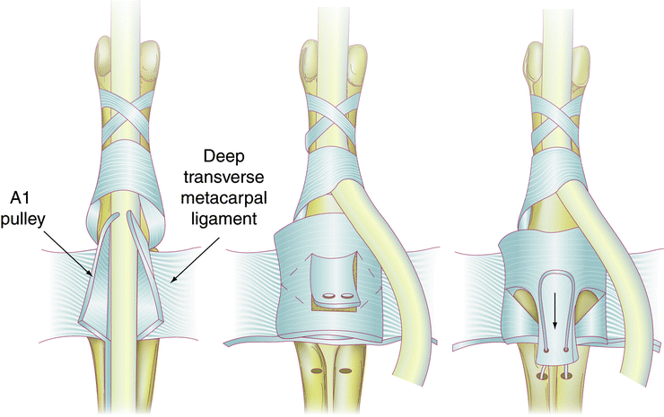 Secondary Procedures for Failed Tendon Transfers | SpringerLink