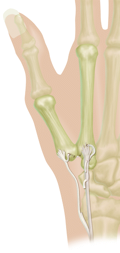 Surgical Options for Failed Thumb Basal Joint Arthroplasty | SpringerLink