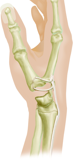 Surgical Options for Failed Thumb Basal Joint Arthroplasty | SpringerLink