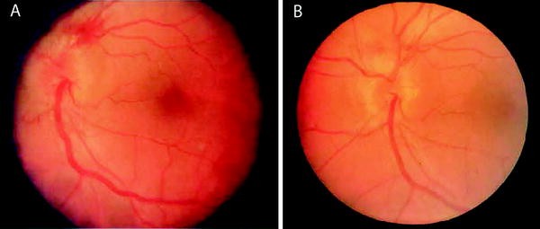 Retinal and Choroidal Manifestations in Bartonellosis, Lyme Disease ...