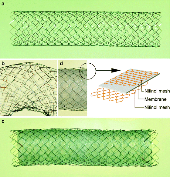 History of Self-Expandable Metal and Self-Expandable Plastic Stent ...