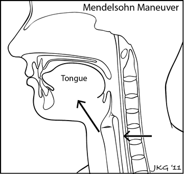Mendelson Maneuver and Masako Maneuver | SpringerLink
