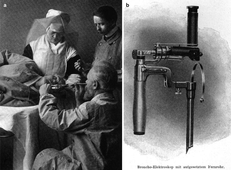 History of the Rigid Bronchoscope | SpringerLink