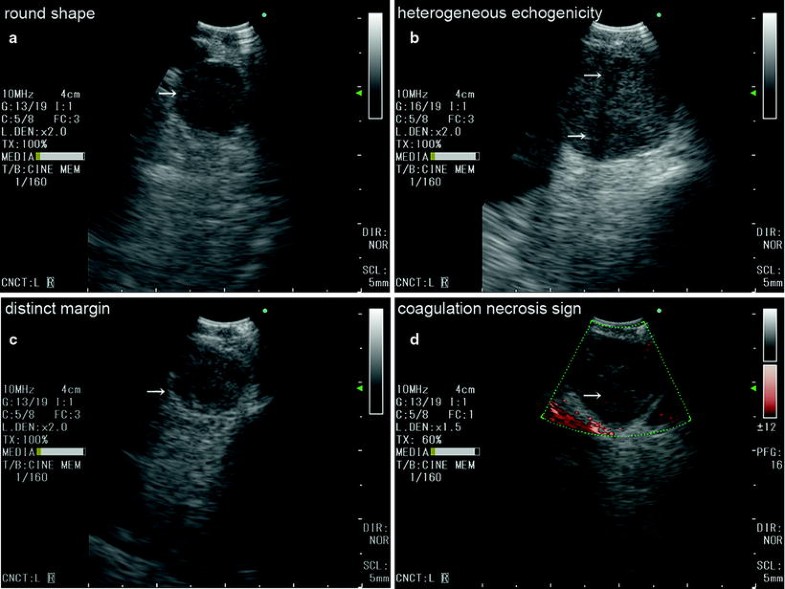 Linear Endobronchial Ultrasound | SpringerLink
