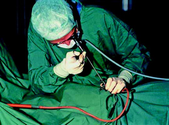 Medical Thoracoscopy/Pleuroscopy | SpringerLink