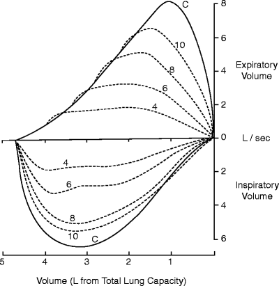 Physiology of Fixed Airway Obstruction | SpringerLink