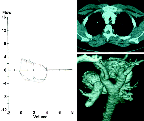 Physiology of Fixed Airway Obstruction | SpringerLink