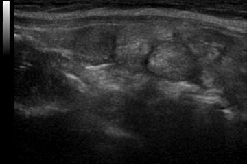 Ultrasound of Diffuse Thyroid Enlargement: Thyroiditis | SpringerLink
