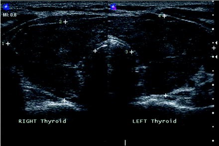 Ultrasound of Diffuse Thyroid Enlargement: Thyroiditis | SpringerLink