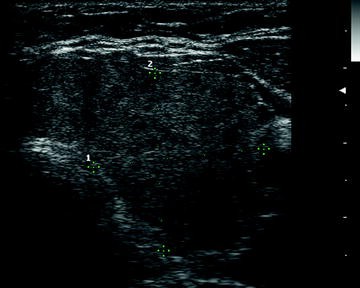 Ultrasound of Diffuse Thyroid Enlargement: Thyroiditis | SpringerLink