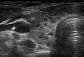 Ultrasound of Diffuse Thyroid Enlargement: Thyroiditis | SpringerLink
