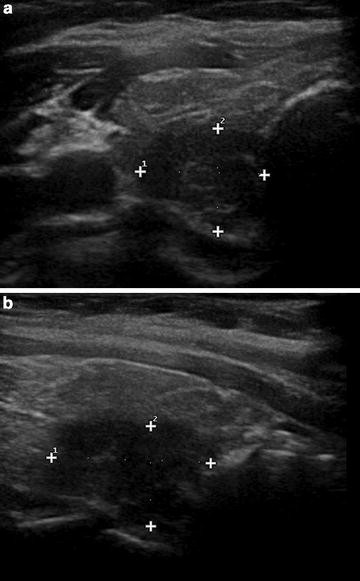 Ultrasound of Diffuse Thyroid Enlargement: Thyroiditis | SpringerLink