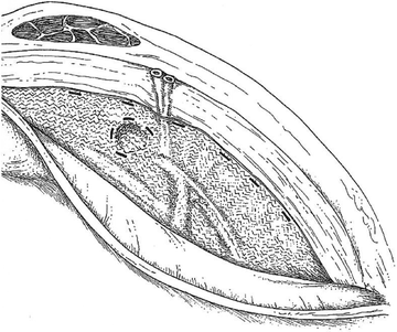 Technique: Laparoscopic TEP | SpringerLink