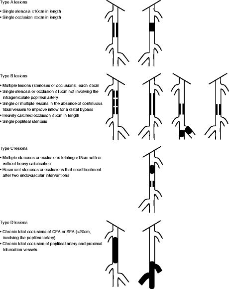 Femoral Artery: CFA, SFA, Profunda Femoris Artery Lesions | SpringerLink