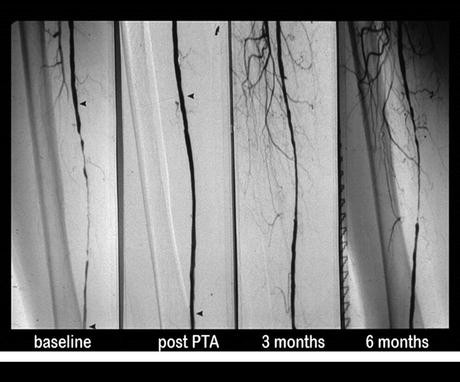 Femoral Artery: CFA, SFA, Profunda Femoris Artery Lesions | SpringerLink