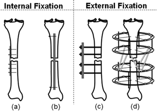 The Design of a Bone Fracture-Fixation Device | SpringerLink