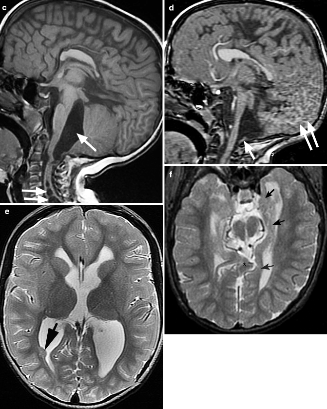 Radiology of the Chiari Malformations | SpringerLink