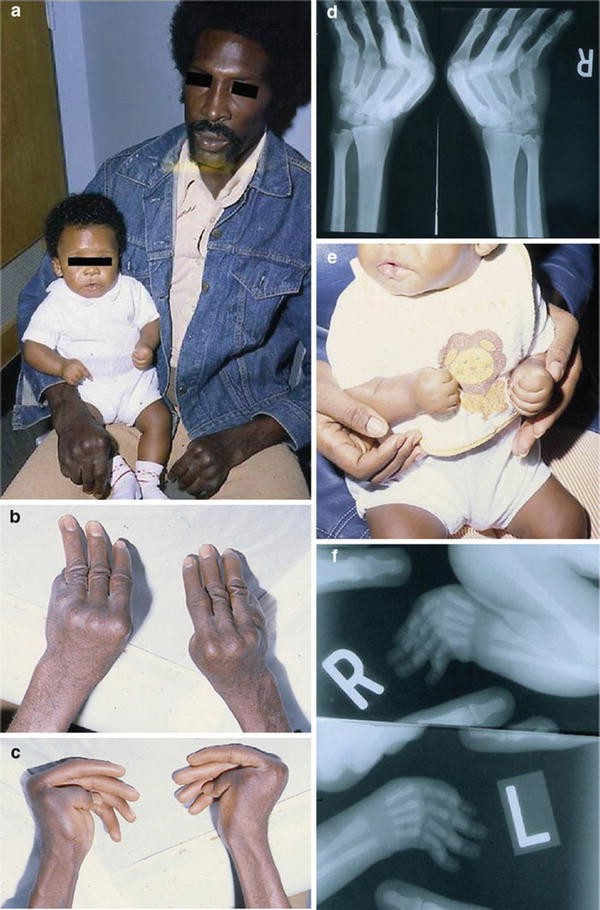 Freeman-Sheldon Syndrome | SpringerLink