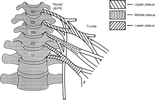Brachial Plexopathies | SpringerLink