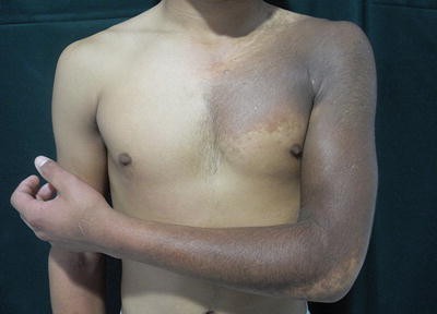 Becker’s Nevus | SpringerLink