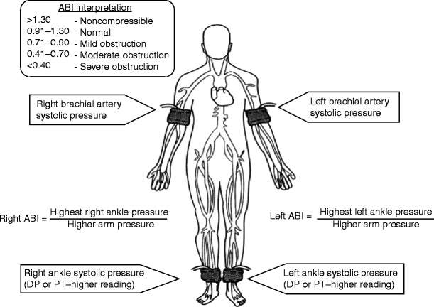 Peripheral Arterial Disease | SpringerLink