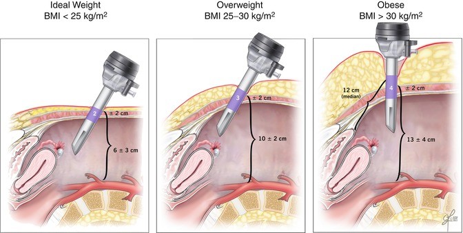 Basic Principles And Anatomy For The Laparoscopic Surgeon Springerlink