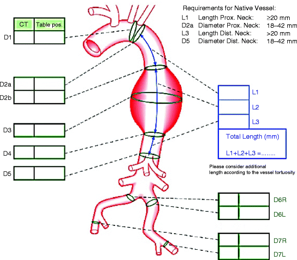 Endovascular Treatment of Type B Aortic Dissection | SpringerLink